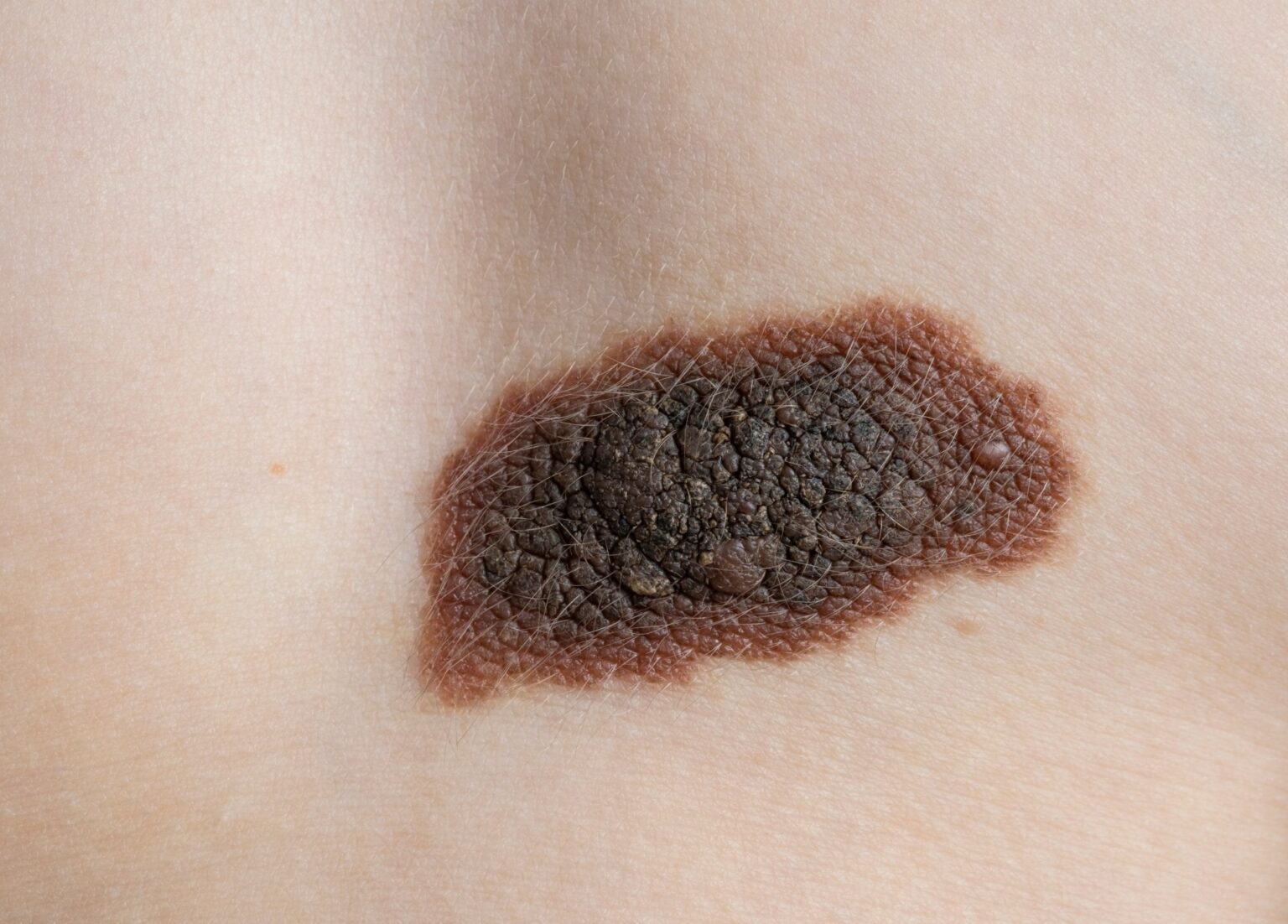 Cartographie des lésions pigmentées à Paris | Chirurgie dermatologique ...